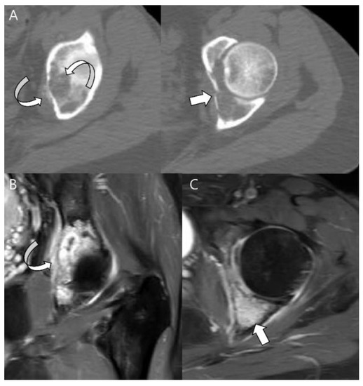 Classification of Chondrosarcoma: From Characteristic to Challenging Imaging Findings