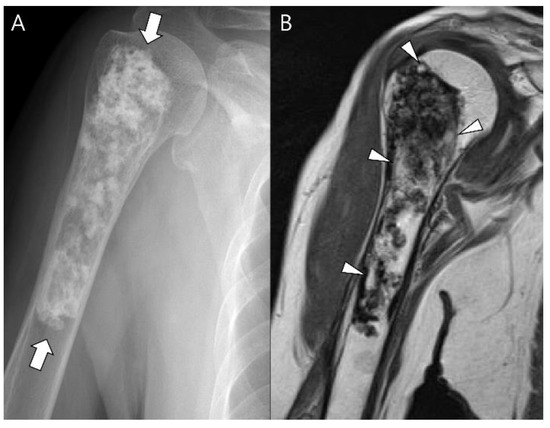 Cancers | Free Full-Text | Classification of Chondrosarcoma: From ...