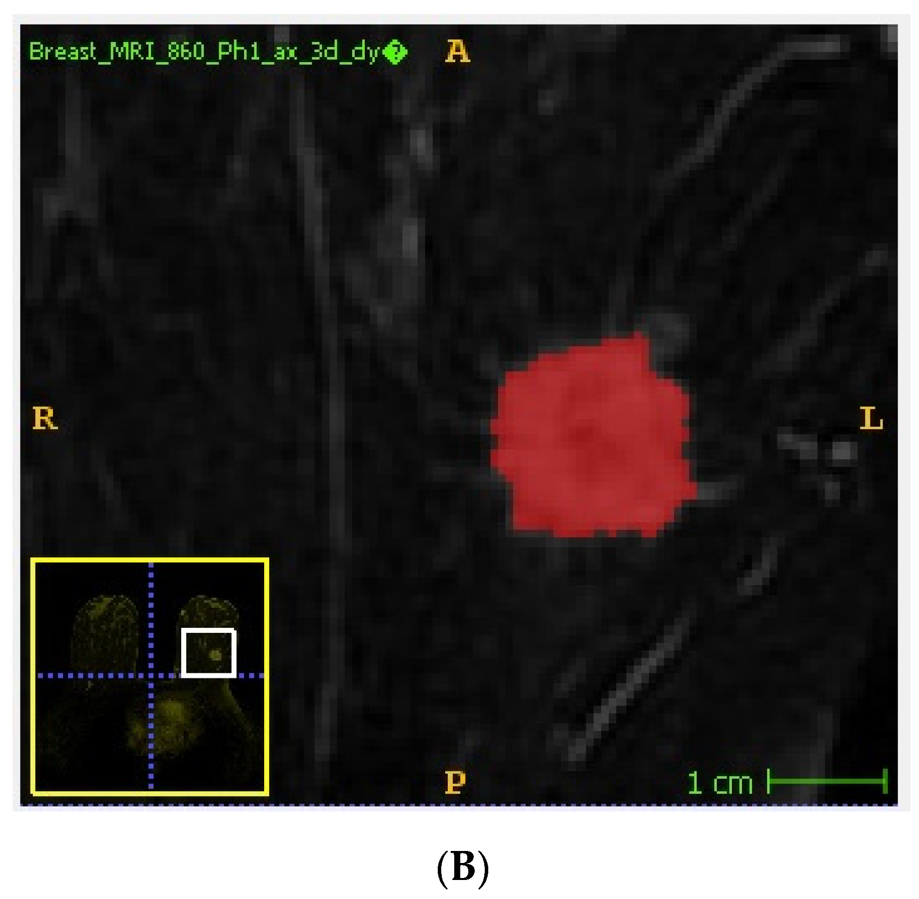 MRI Radiomics and Machine Learning for the Prediction of Oncotype Dx ...