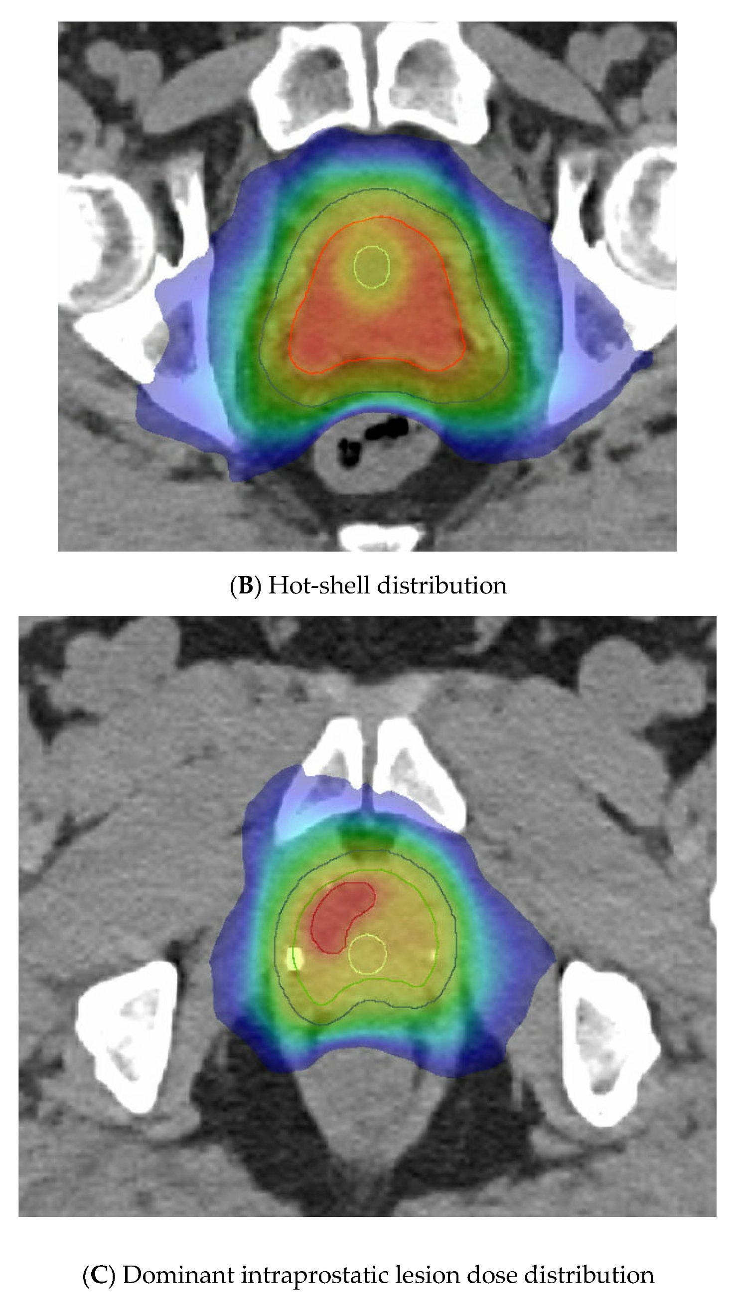 Virtual HDR Boost for Prostate Cancer: Rebooting a Classic Treatment ...