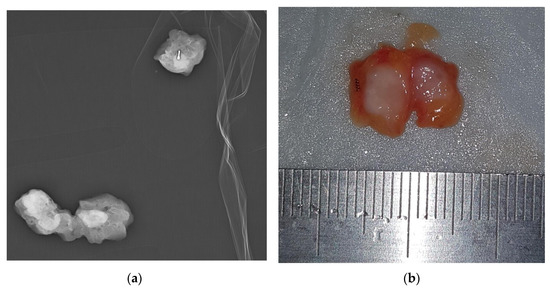Selective Axillary Dissection after Neoadjuvant Chemotherapy in ...