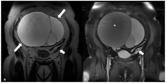 Manifestations of Ovarian Cancer in Relation to Other Pelvic Diseases ...