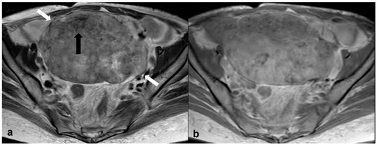 Manifestations of Ovarian Cancer in Relation to Other Pelvic Diseases ...