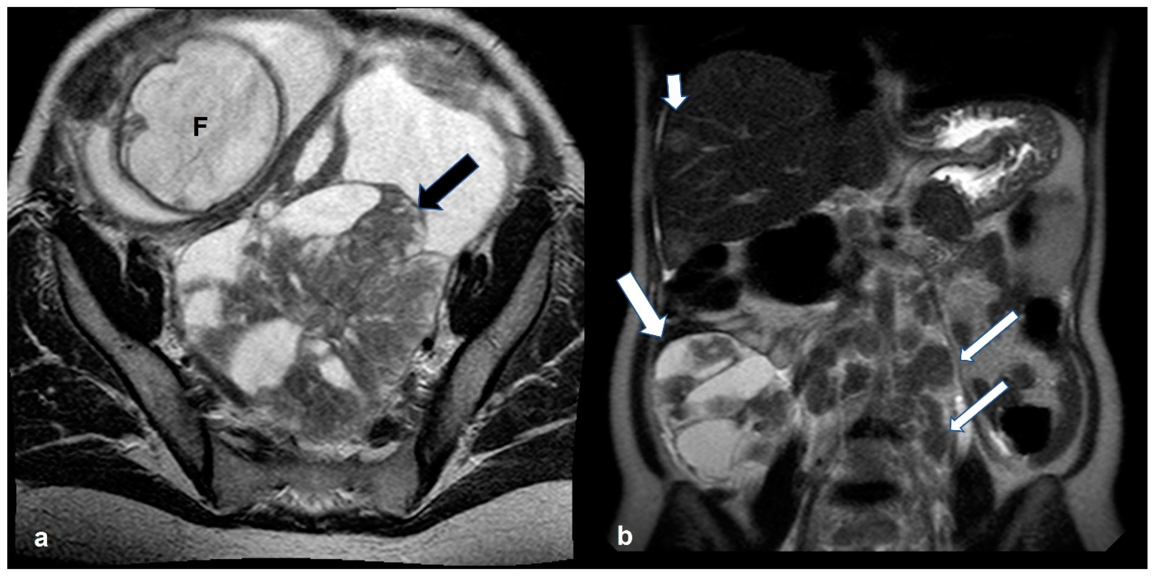 Cancers Free Full Text Manifestations Of Ovarian Cancer In Relation To Other Pelvic Diseases