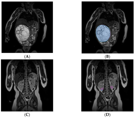 Cancers Free Full Text Radiologic Versus Segmentation Measurements