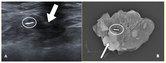 Image-Guided Localization Techniques for Metastatic Axillary Lymph ...