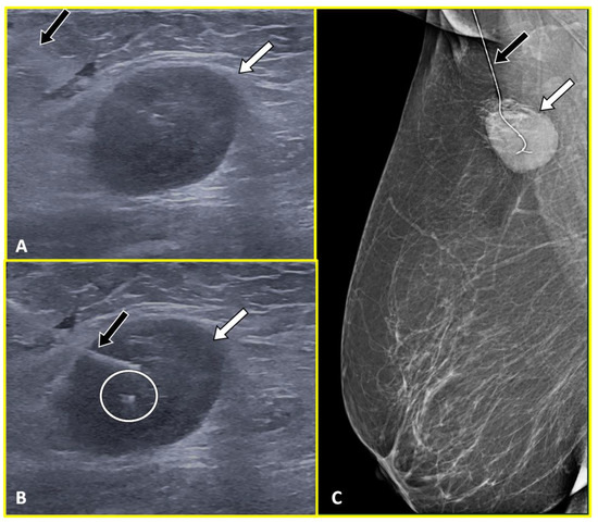 Image-Guided Localization Techniques for Metastatic Axillary Lymph ...