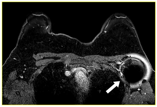 Image-Guided Localization Techniques for Metastatic Axillary Lymph ...
