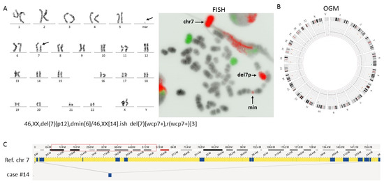 Optical Genome Mapping in Routine Cytogenetic Diagnosis of Acute Leukemia