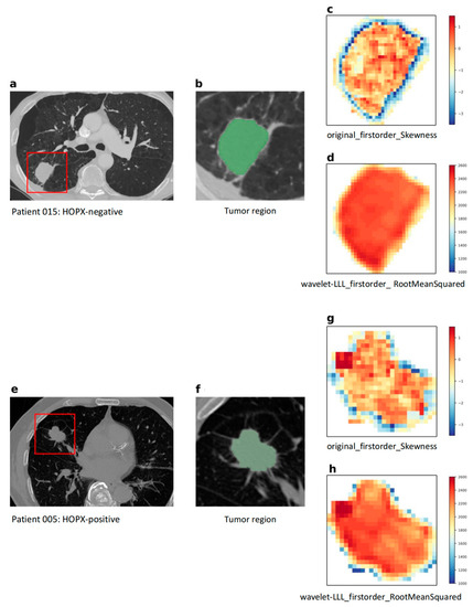 CT Image-Based Biopsy to Aid Prediction of HOPX Expression Status and ...