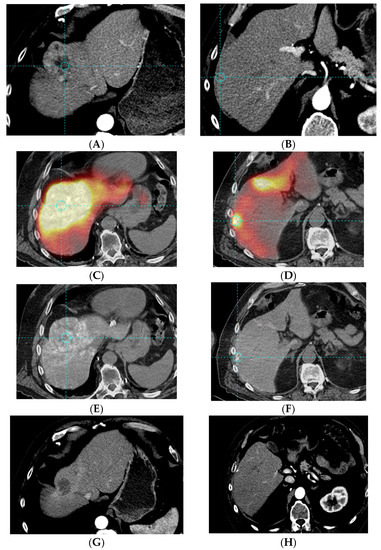 188Re-SSS Lipiodol Radioembolization in HCC Patients: Results of a ...