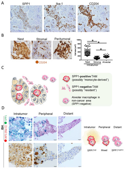 The Significance of SPP1 in Lung Cancers and Its Impact as a Marker for ...