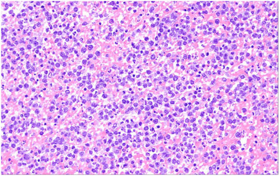 Large B-Cell Lymphomas in the 5th Edition of the WHO-Classification of ...