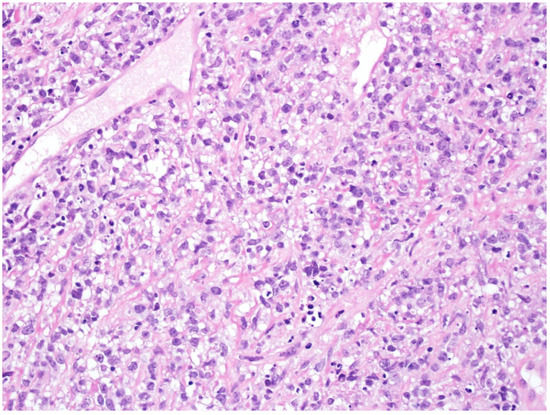 Large B-Cell Lymphomas in the 5th Edition of the WHO-Classification of ...