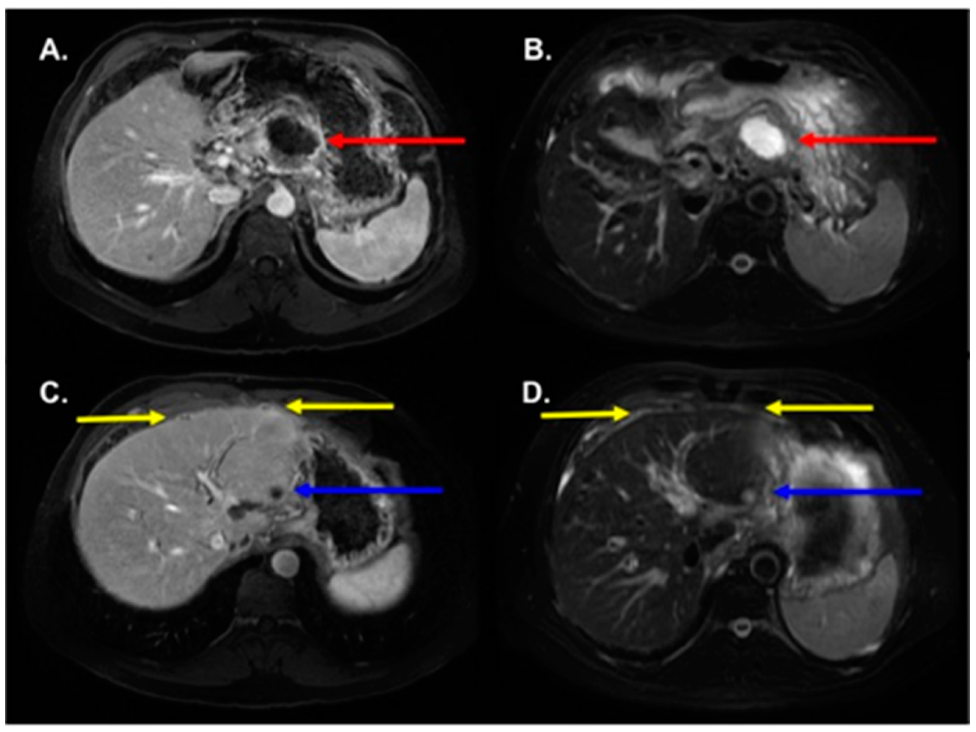 MRI-Based Tumor Necrosis Depiction in Pancreatic Ductal Adenocarcinoma ...