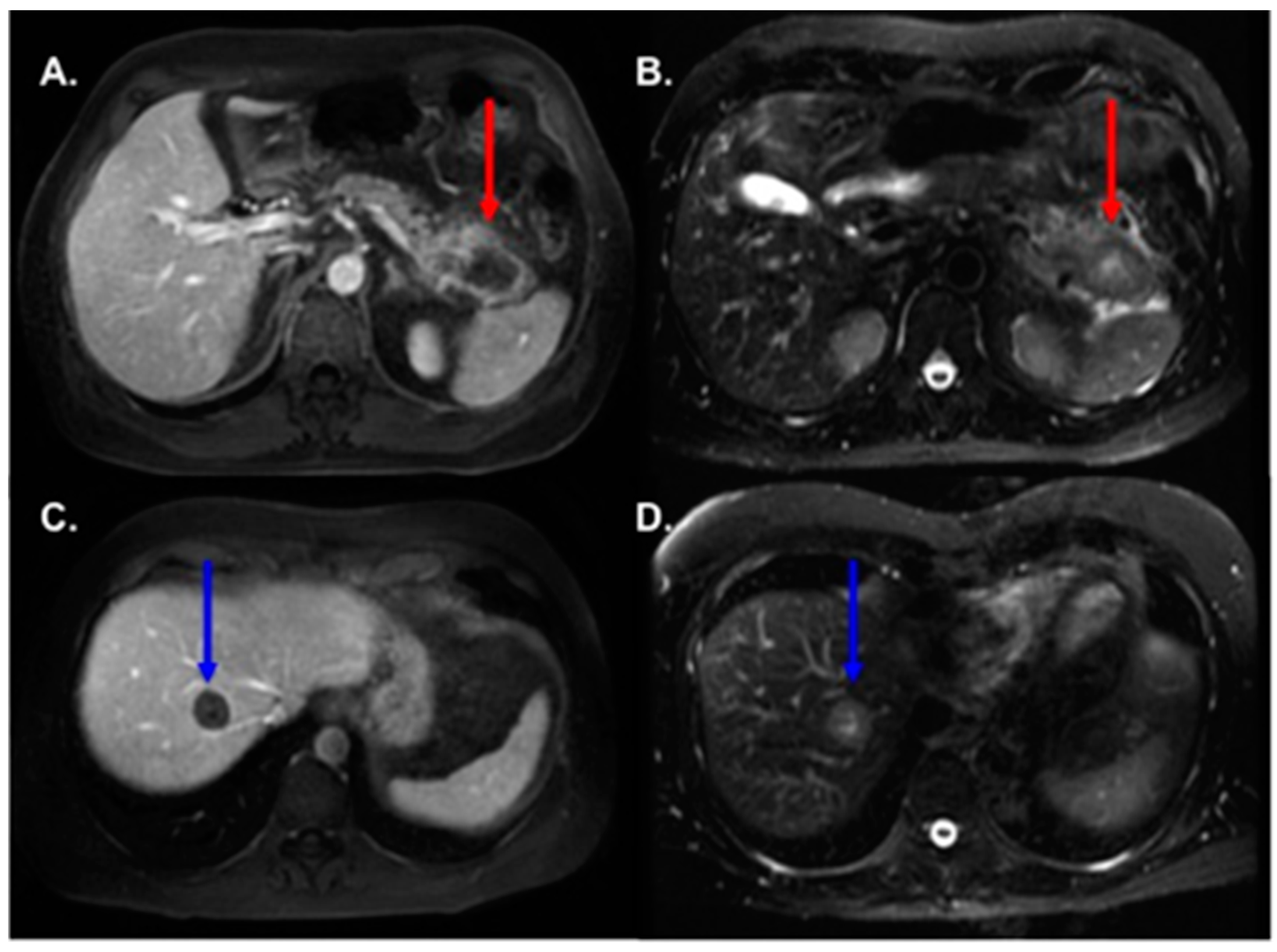 MRI-Based Tumor Necrosis Depiction in Pancreatic Ductal Adenocarcinoma ...