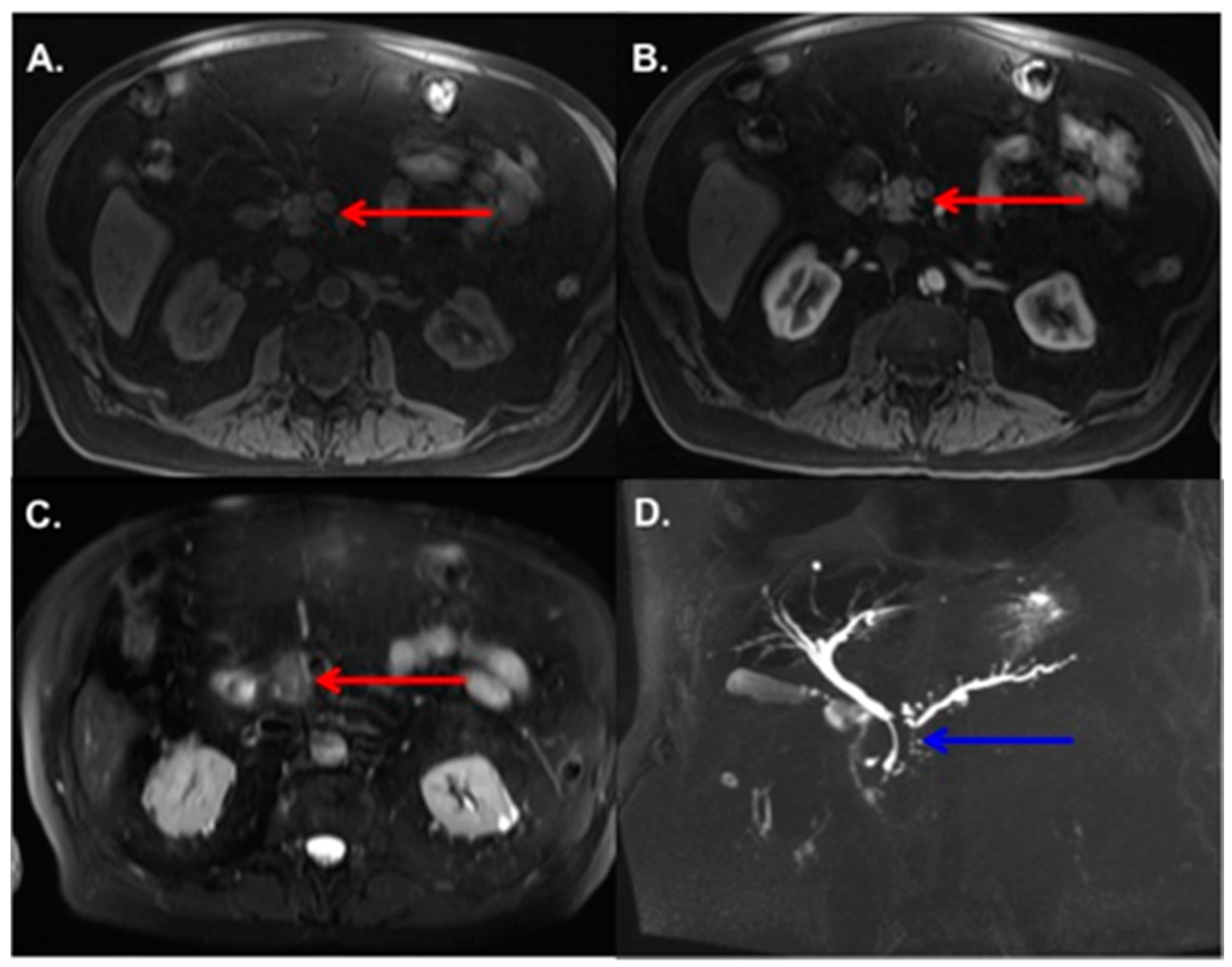 MRI-Based Tumor Necrosis Depiction in Pancreatic Ductal Adenocarcinoma ...