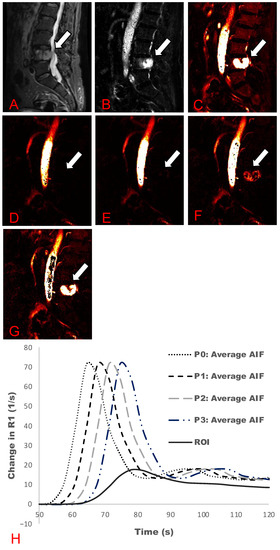 Delay of Aortic Arterial Input Function Time Improves Detection of Malignant Vertebral Body ...