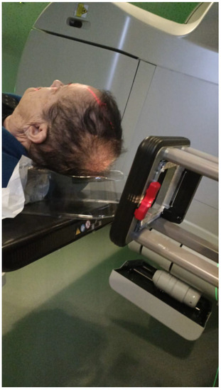 The Role of Radiation Therapy in the Treatment of Non-Melanoma Skin Cancer