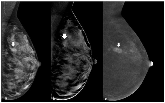Breast Digital Tomosynthesis versus Contrast-Enhanced Mammography: Comparison of Diagnostic ...