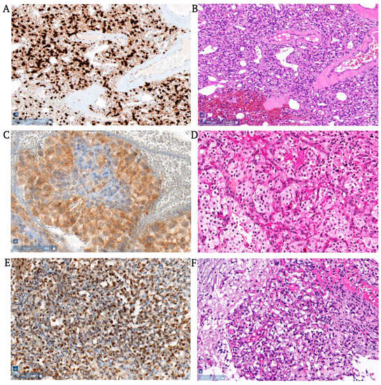 Expression of Hemangioblast Proteins in von Hippel-Lindau Disease ...