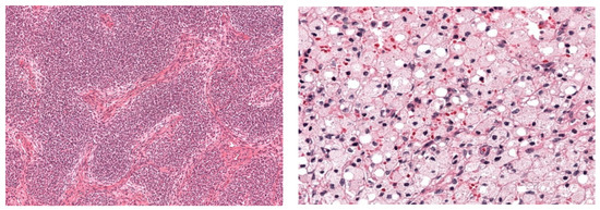 Automated Deep Learning-Based Classification of Wilms Tumor Histopathology