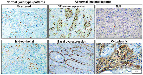 P53 in Penile Squamous Cell Carcinoma: A Pattern-Based ...