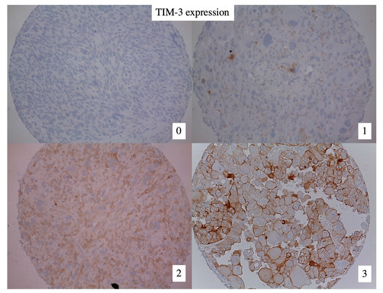TIM-3 Qualifies as a Potential Immunotherapeutic Target in Specific ...