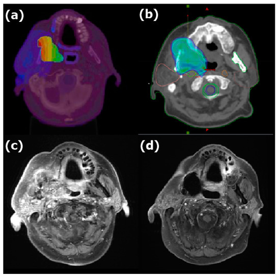 Boron Neutron Capture Therapy Followed by Image-Guided Intensity ...