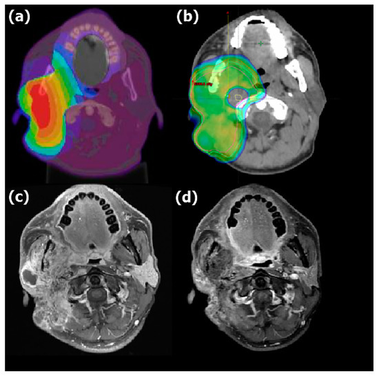 Boron Neutron Capture Therapy Followed by Image-Guided Intensity ...