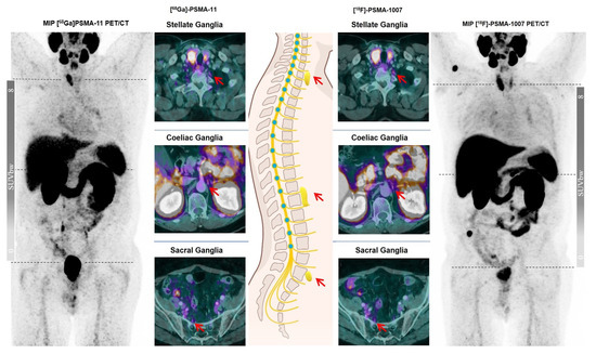 Intra-Individual Comparison of Physiologic [68Ga]Ga-PSMA-11 and [18F ...