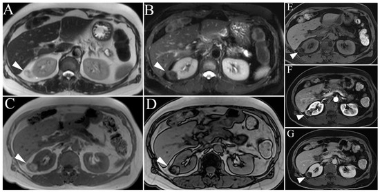 MR Virtual Biopsy of Solid Renal Masses: An Algorithmic Approach