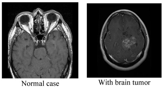 Cancers | Free Full-Text | Efficient Brain Tumor Detection with ...