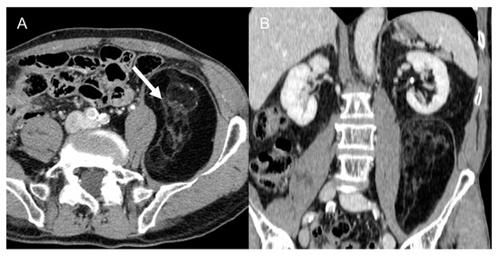 CT and MR Imaging of Retroperitoneal Sarcomas: A Practical Guide for ...