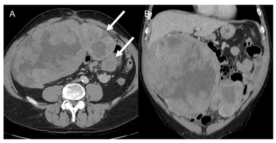 CT and MR Imaging of Retroperitoneal Sarcomas: A Practical Guide for ...
