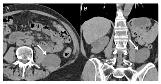 CT and MR Imaging of Retroperitoneal Sarcomas: A Practical Guide for ...