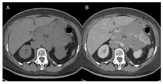 CT and MR Imaging of Retroperitoneal Sarcomas: A Practical Guide for ...