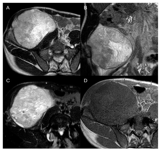 CT and MR Imaging of Retroperitoneal Sarcomas: A Practical Guide for ...