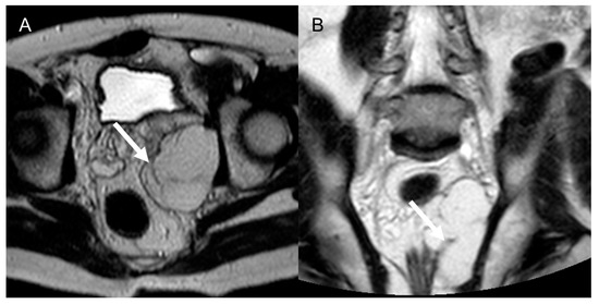 CT and MR Imaging of Retroperitoneal Sarcomas: A Practical Guide for ...