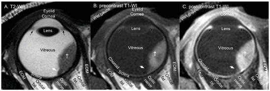 Magnetic Resonance Imaging in the Clinical Care for Uveal Melanoma ...