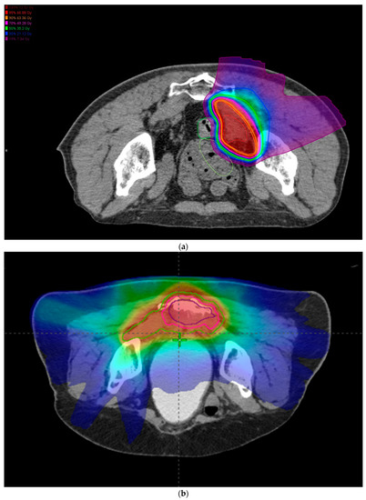 Comparing Oncologic Outcomes and Toxicity for Combined Modality Therapy vs. Carbon-Ion ...