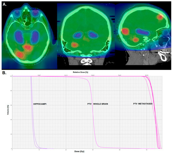 PRO: Do We Still Need Whole-Brain Irradiation for Brain Metastases?