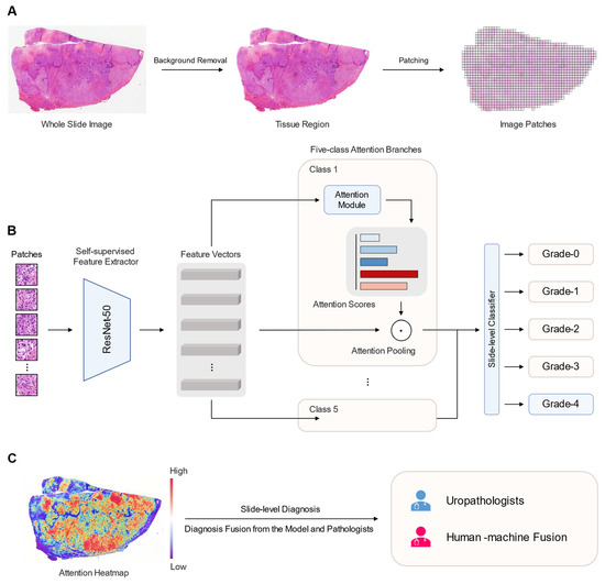A Weakly Supervised Deep Learning Model and Human–Machine Fusion for Accurate Grading of Renal ...