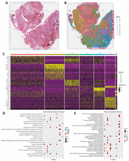 Cancers | Free Full-Text | Spatial Transcriptomics Identifies Expression Signatures Specific to ...