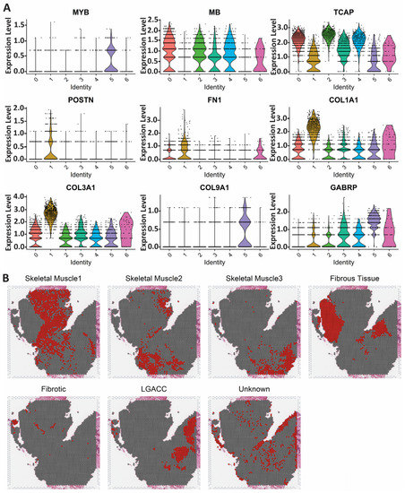 Cancers | Free Full-Text | Spatial Transcriptomics Identifies ...