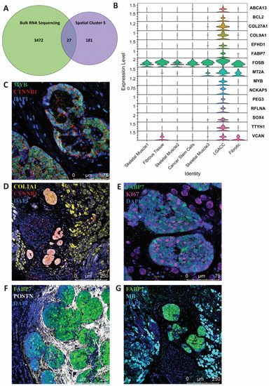 Cancers | Free Full-Text | Spatial Transcriptomics Identifies ...