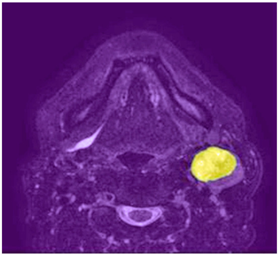 Recent Advances in Deep Learning and Medical Imaging for Head and Neck ...
