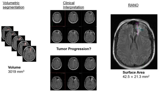 Evaluation of RANO Criteria for the Assessment of Tumor Progression for ...