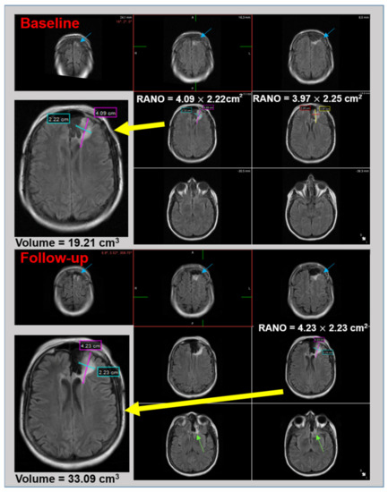 Evaluation of RANO Criteria for the Assessment of Tumor Progression for ...