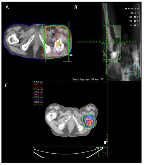 The Role of Post-Operative Radiotherapy for Non-Spine Bone Metastases ...
